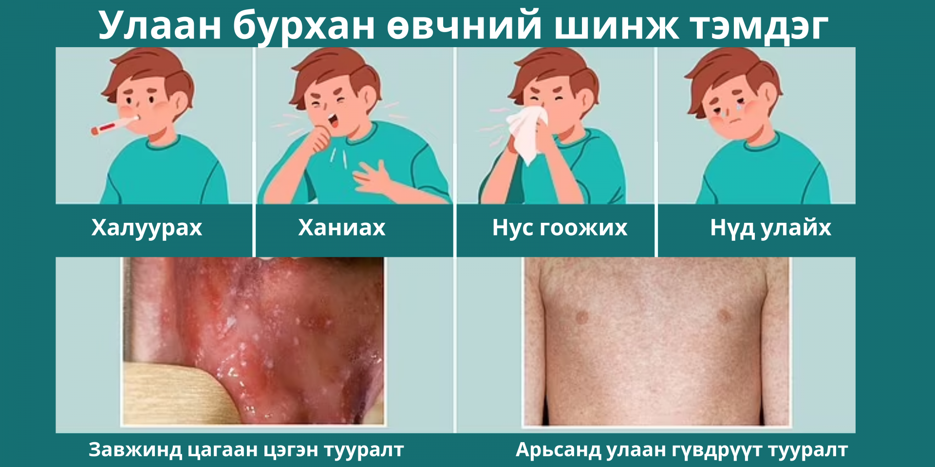 Улаан бурхны халдварын дэгдэлт ба анхаарах зүйлс Humanz